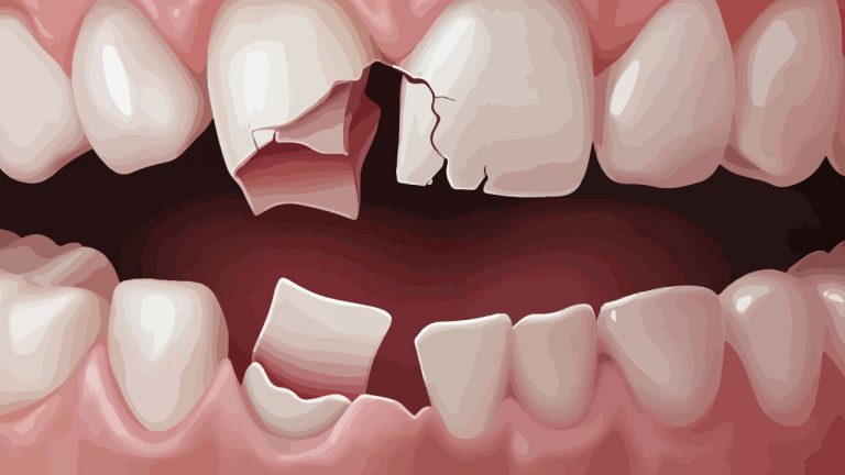 How to Fix a Cracked Tooth: Causes, Treatments & Prevention - MySmile ...
